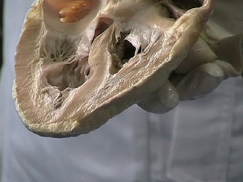 Cardiología Clínica Integral: Fibroelastosis Endocárdica